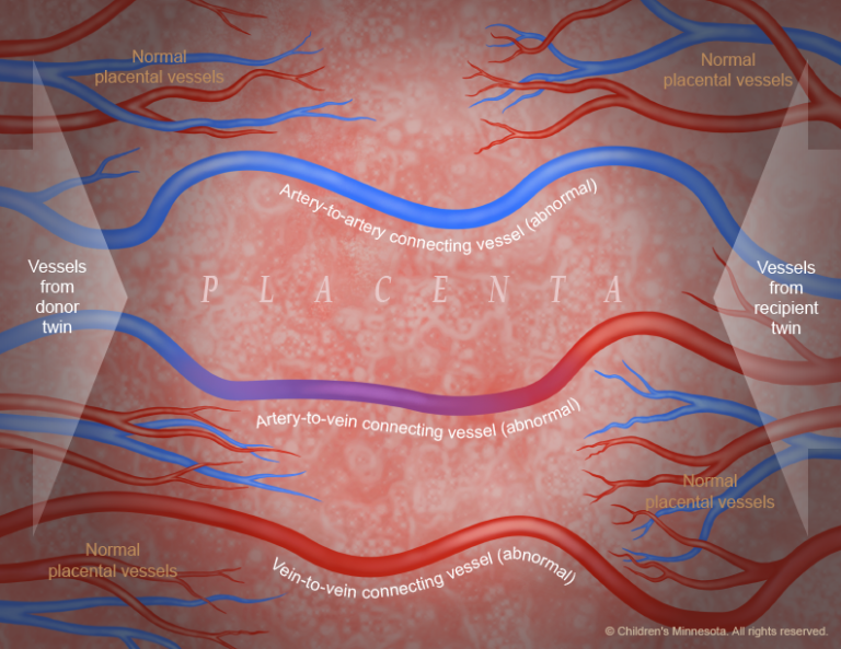 Twin To Twin Transfusion Syndrome (TTTS) Treatment - Children's Minnesota
