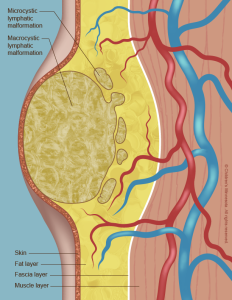 Lymphatic malformation treatments | Children's Minnesota