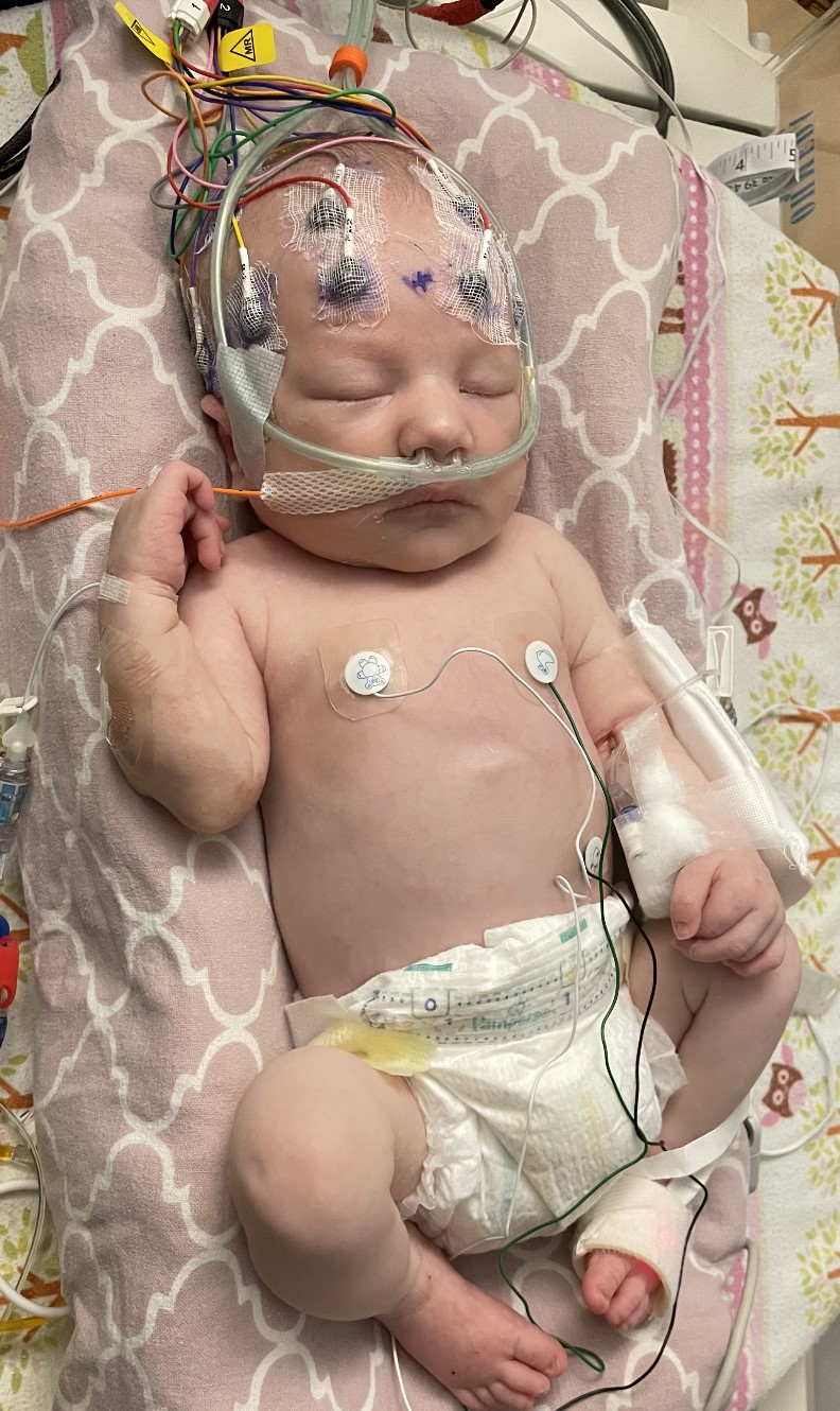 Baby Diana becomes Minnesota’s youngest patient to receive cochlear ...