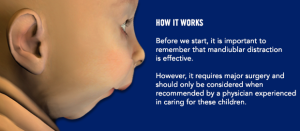 Mandibular Distraction Surgery | Children's Minnesota