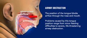 Mandibular Distraction Surgery | Children's Minnesota