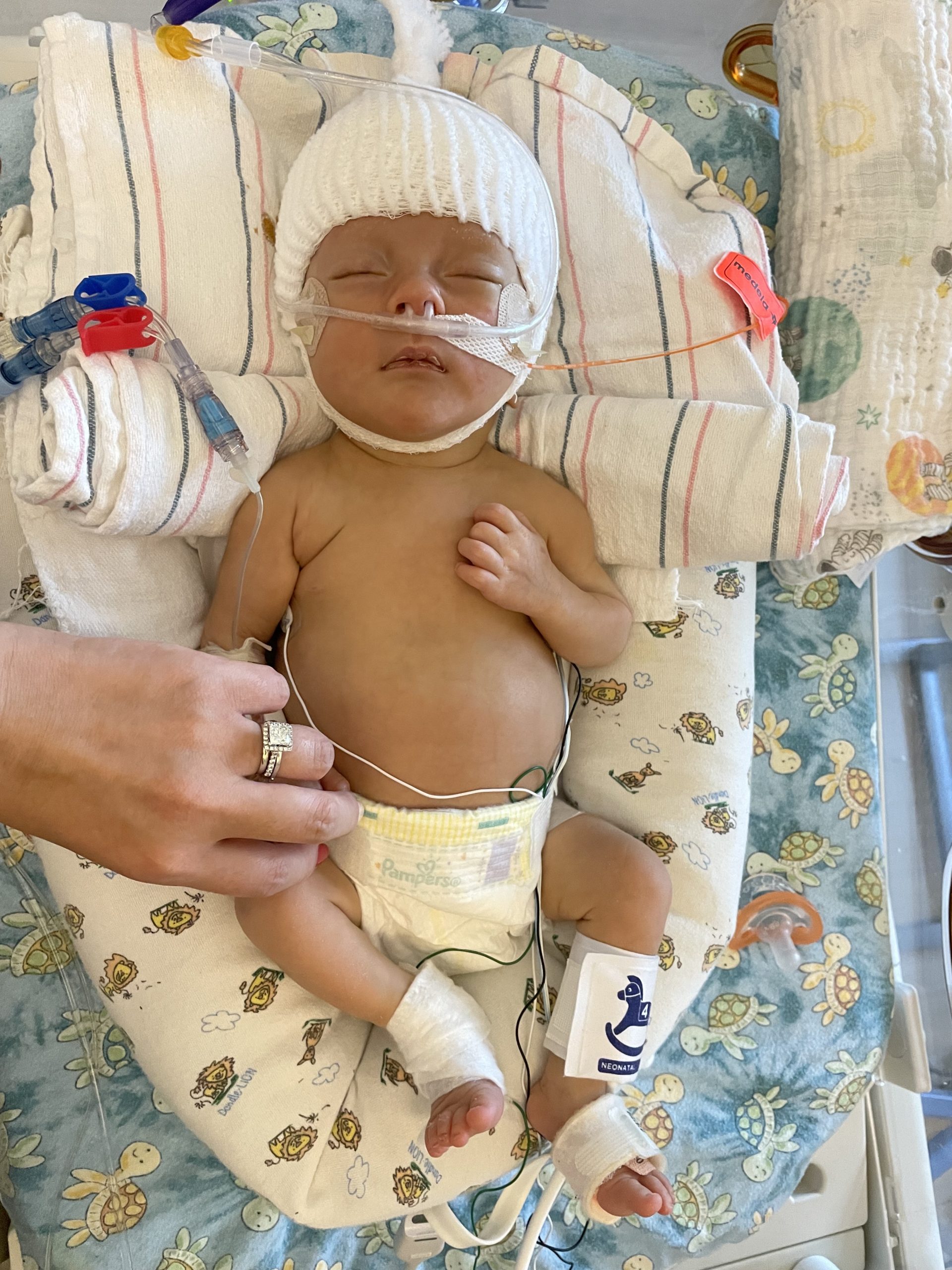 Baby Harrison defies odds, overcomes complication after complication ...