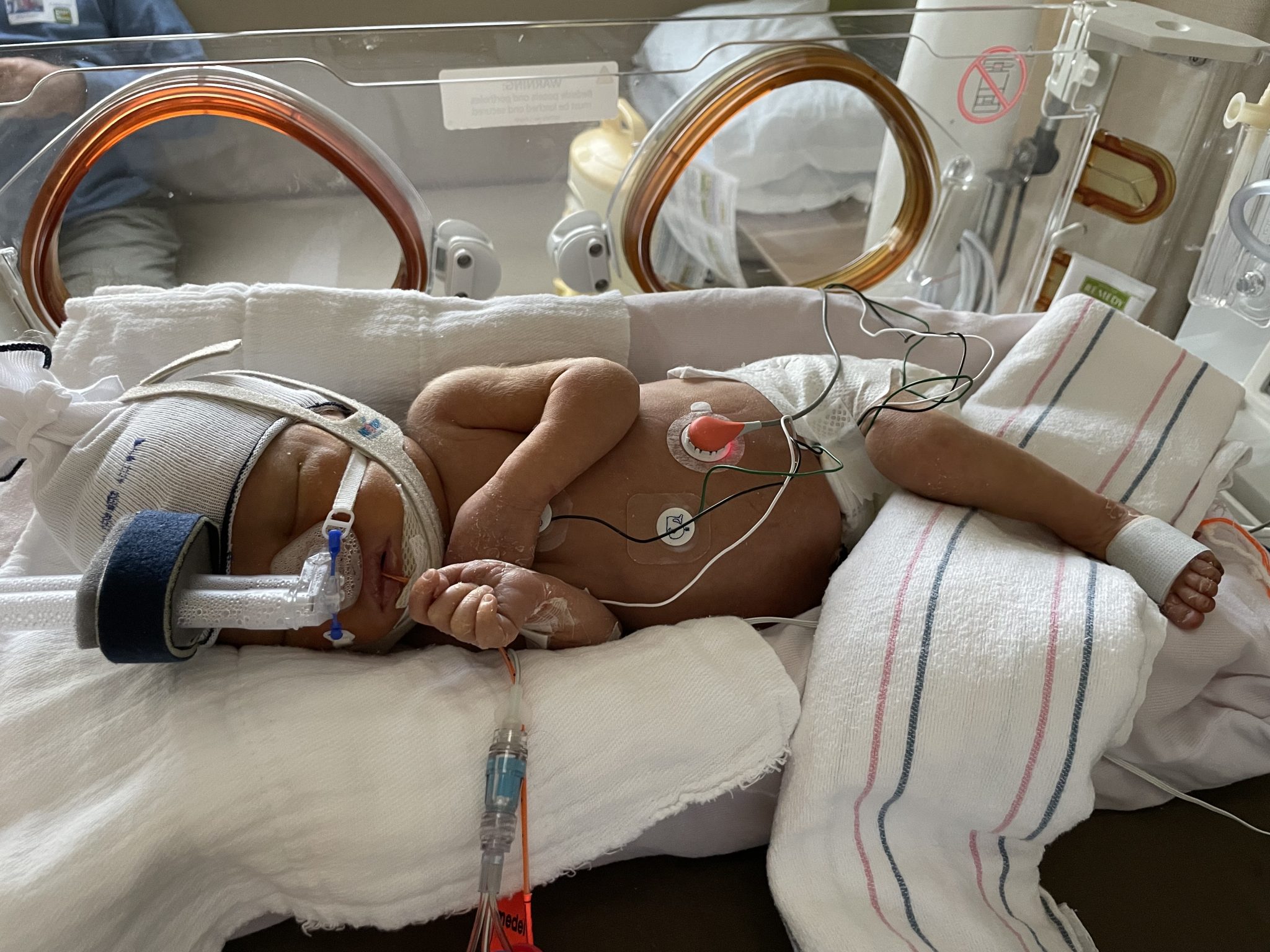 Baby Harrison defies odds, overcomes complication after complication ...