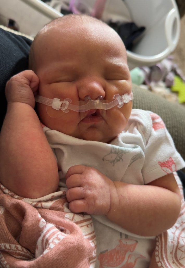 New cleft lip treatment helps Luna to her 'forever smile' - Children's ...