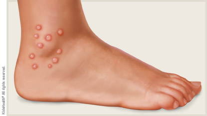 Picaduras de coloradilla