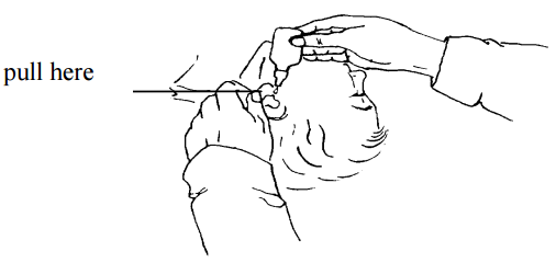 Ear drops : Neonatal Journey to Home
