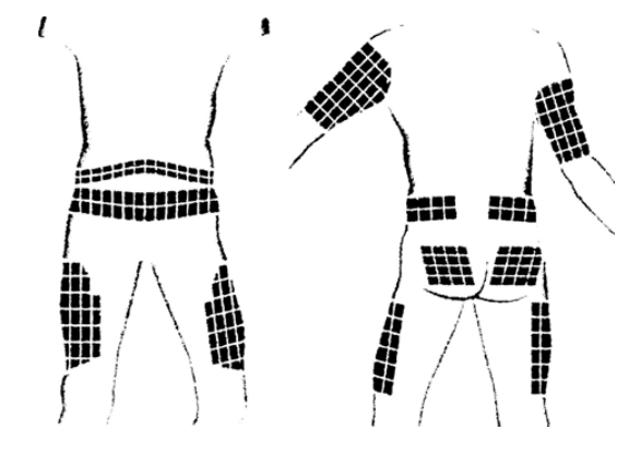 Injections (subcutaneous) : Neonatal Journey to Home